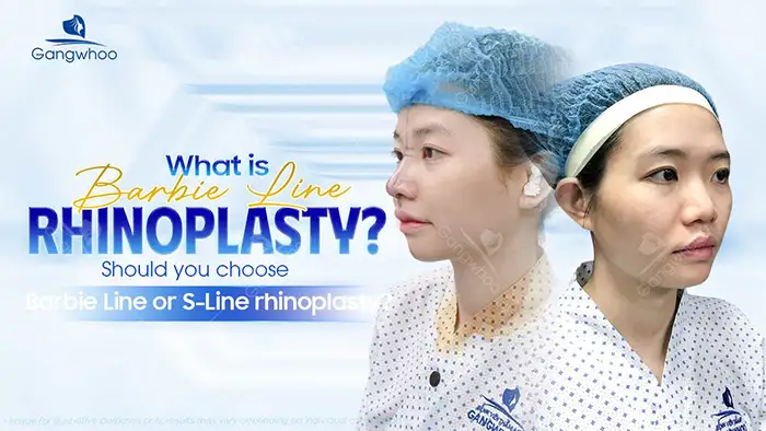 What Is Barbie Line Rhinoplasty? Should You Choose Barbie Line or S ...