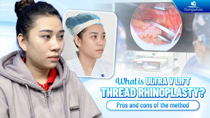 What Is Ultra V Lift Thread Nose Lift? Advantages and Disadvantages of ...